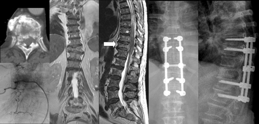 Metastasen und Tumoren der Wirbelsäule | Sana Kliniken Leipziger Land